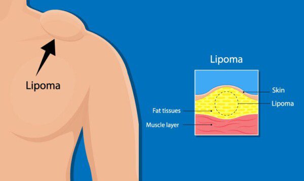 Best Home Remedies For Lipoma