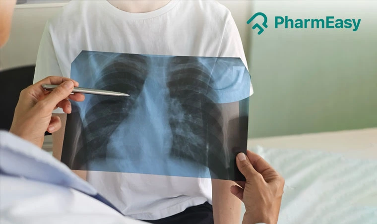 Lobar Pneumonia: What Is It, Causes, Symptoms & Treatment | PharmEasy